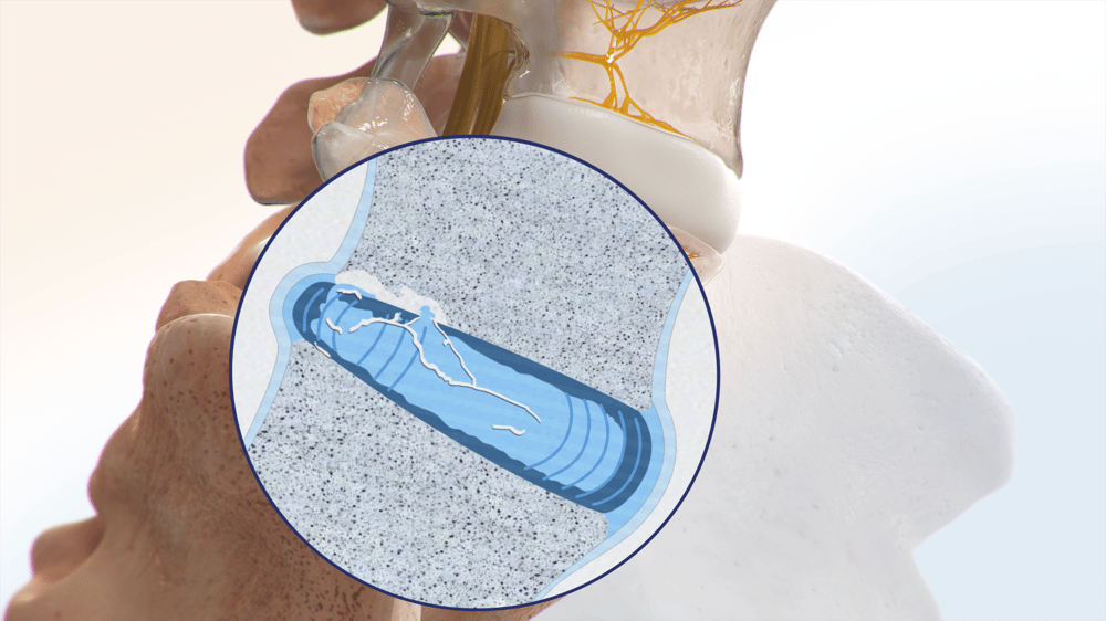 AZ Pain Doctors | Intracept