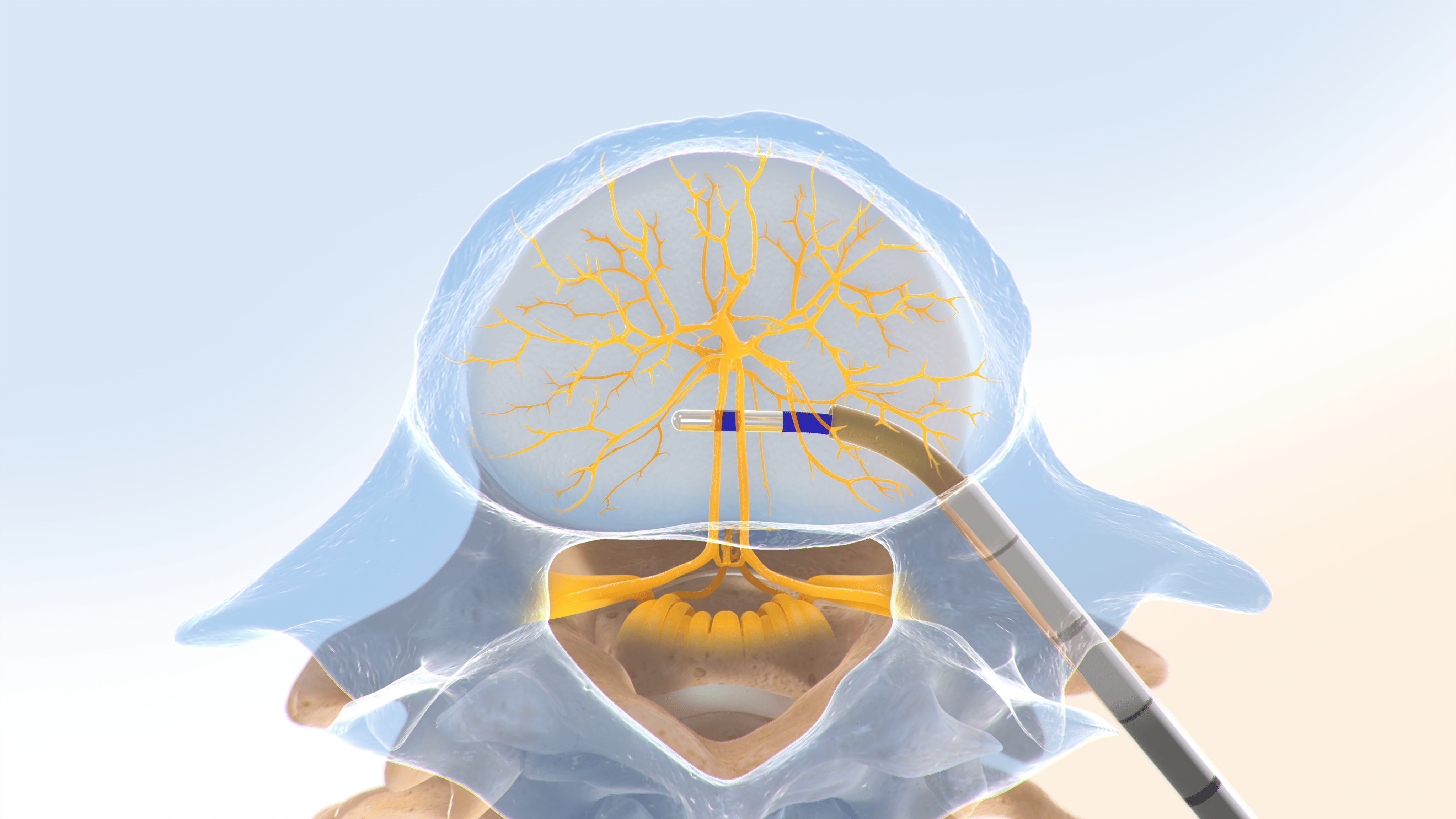 AZ Pain Doctors | Intracept