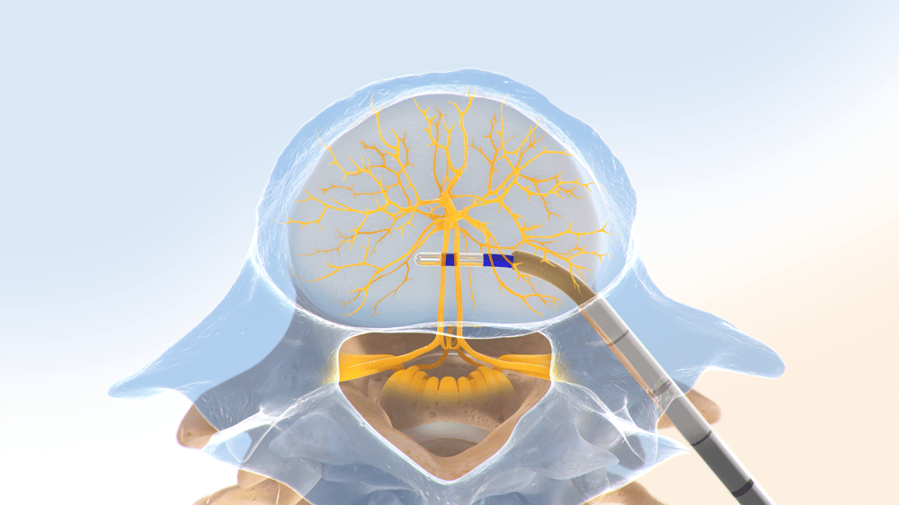 AZ Pain Doctors | Intracept